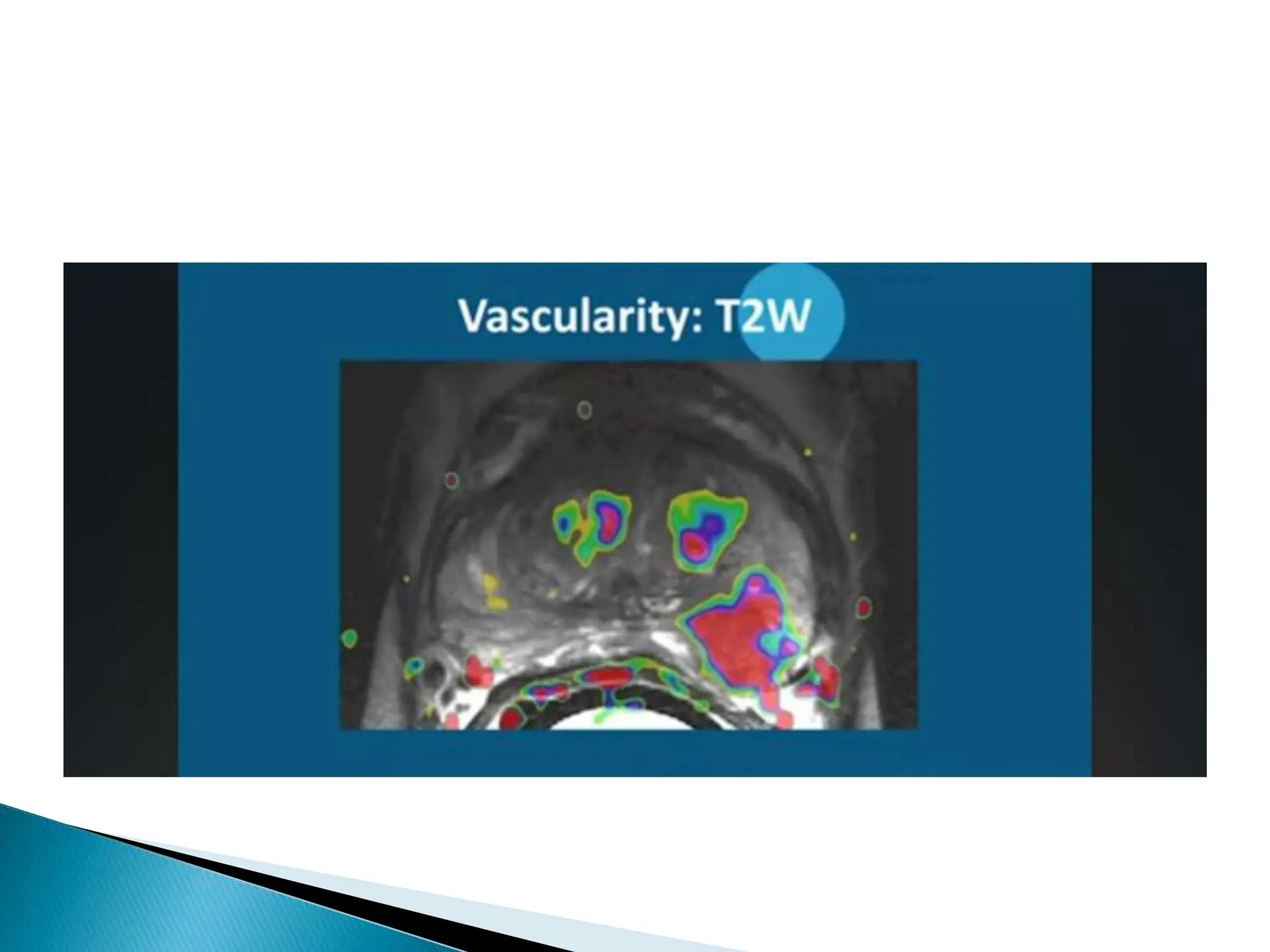 Diagnosis, Staging and Management of CA Prostate | PPT