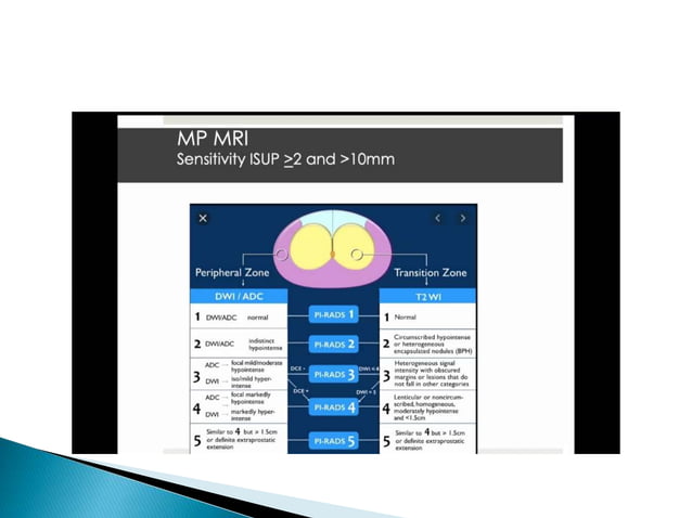 Diagnosis, Staging and Management of CA Prostate | PPT