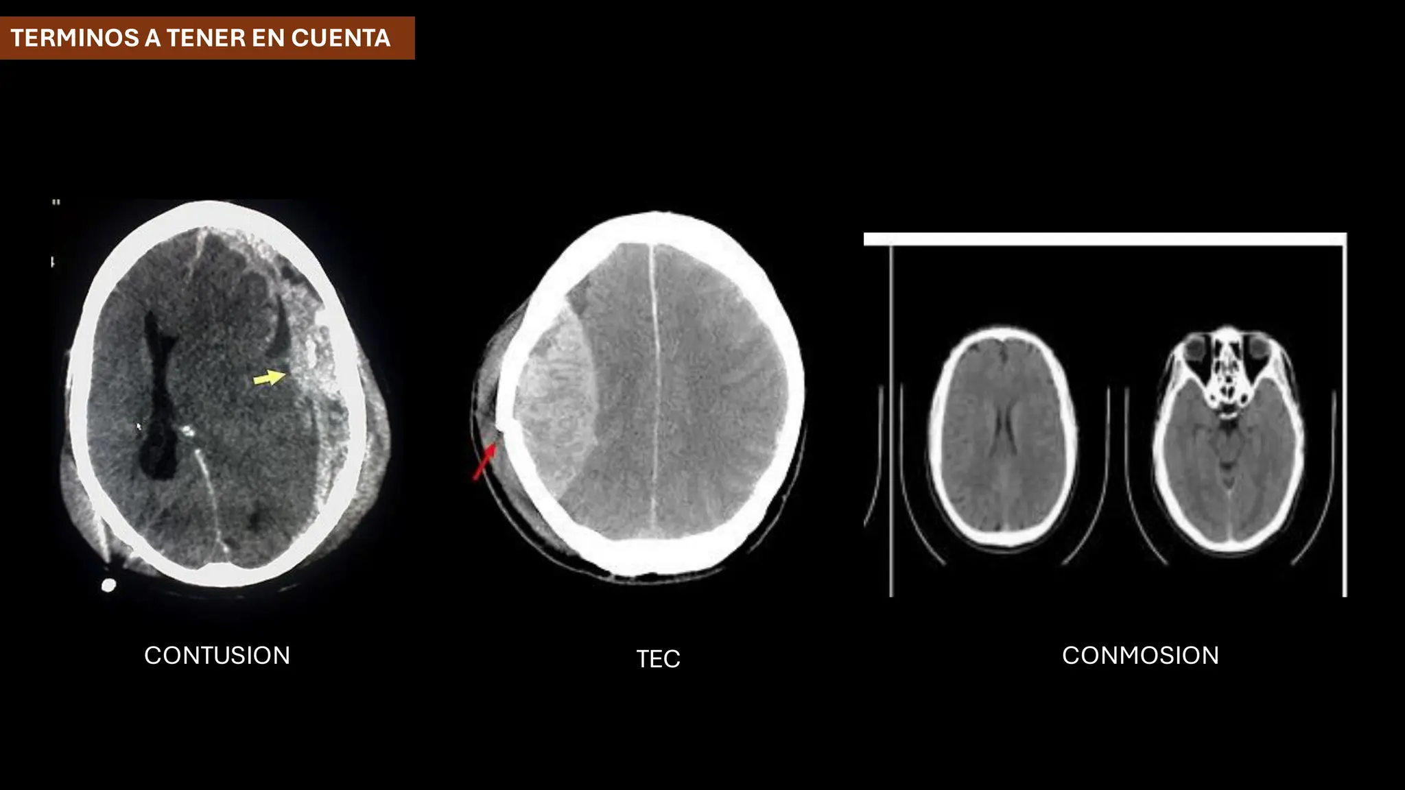 Contusión cerebral en neurocirugia ........ | PPT