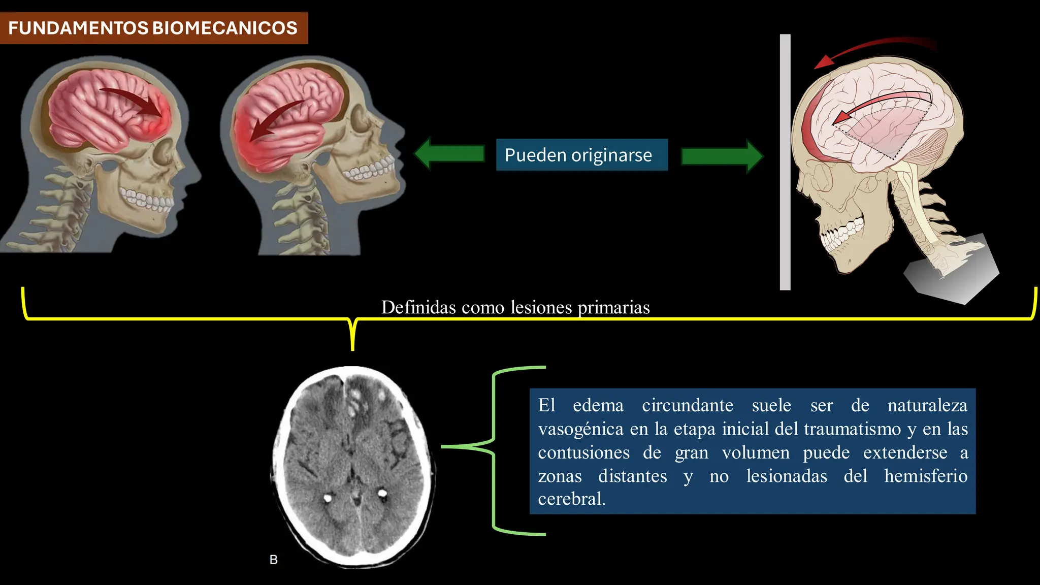 Contusión cerebral en neurocirugia ........ | PPT