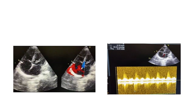 TAPVR with vertical vein obstruction.... | PPT