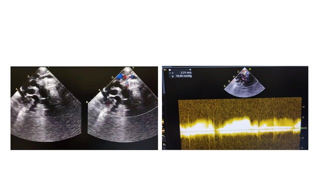 TAPVR with vertical vein obstruction.... | PPT