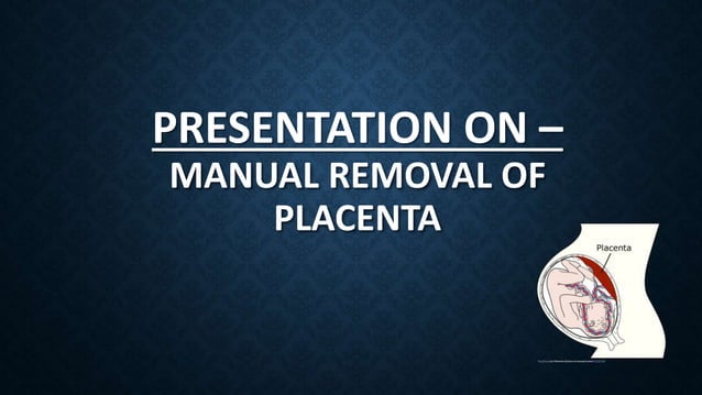 Manual removal of placenta ......ppt by sanjna thakur | PPTX ...