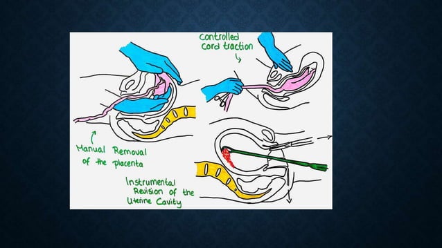 Manual removal of placenta ......ppt by sanjna thakur | PPTX ...