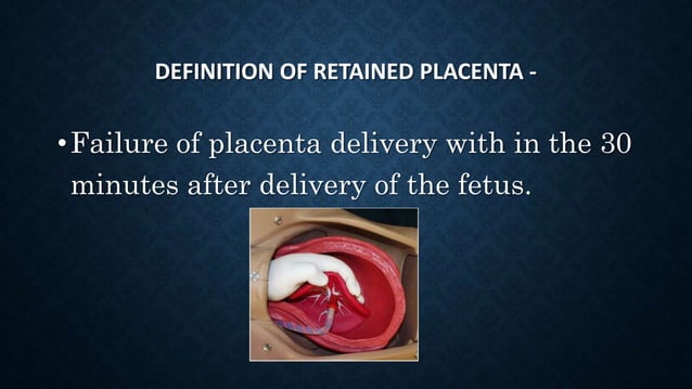 Manual removal of placenta ......ppt by sanjna thakur | PPTX ...