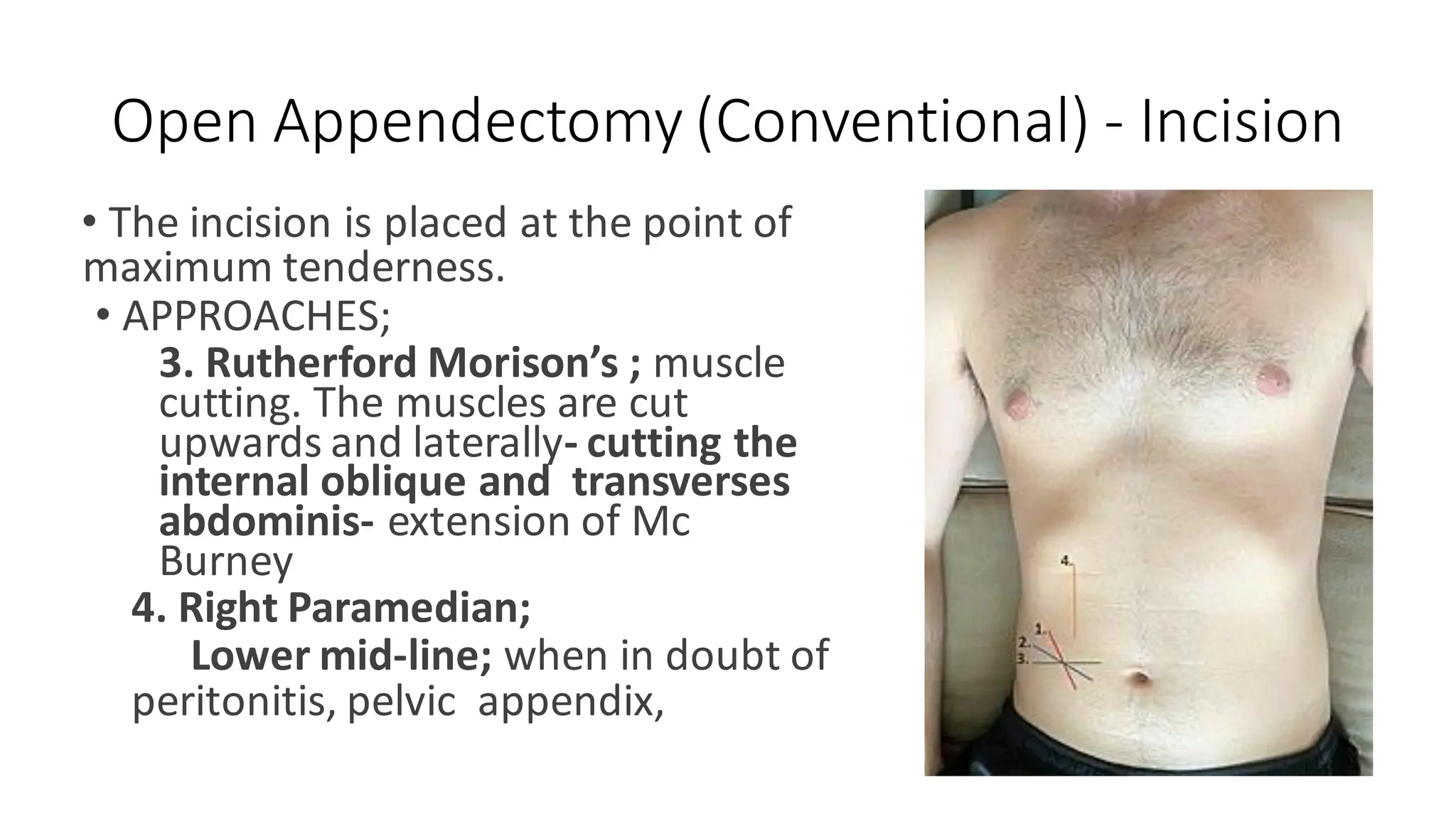 APPENDECTOMY PRESENTATION BY GENERAL SURGERY | PDF