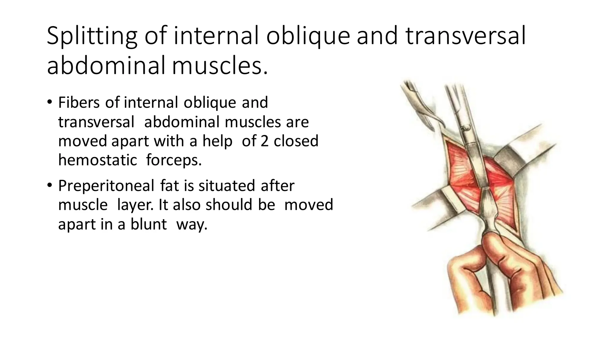 APPENDECTOMY PRESENTATION BY GENERAL SURGERY | PDF