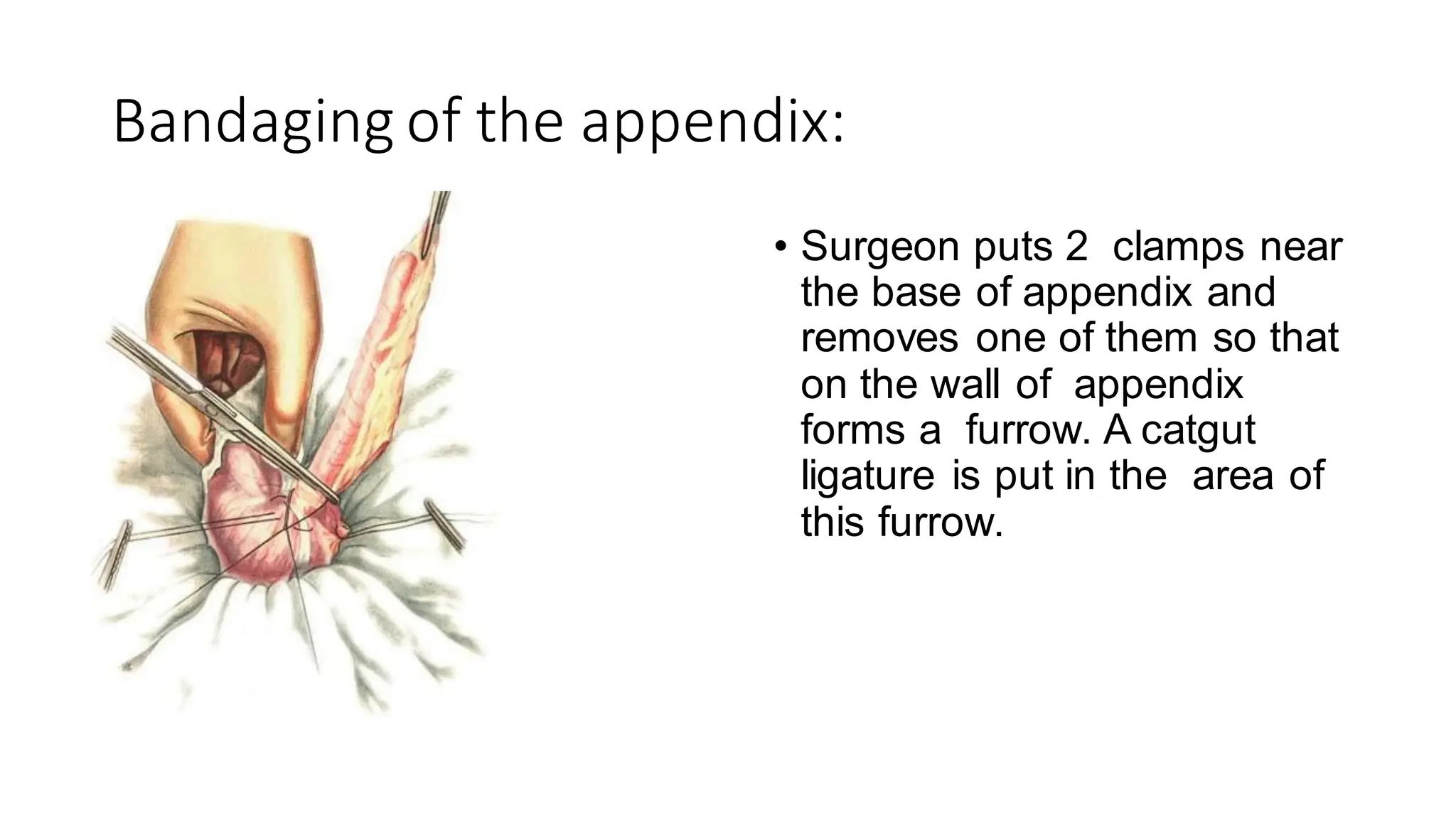APPENDECTOMY PRESENTATION BY GENERAL SURGERY | PDF
