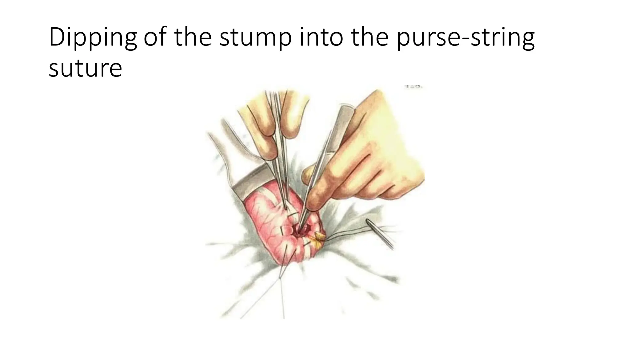 APPENDECTOMY PRESENTATION BY GENERAL SURGERY | PDF