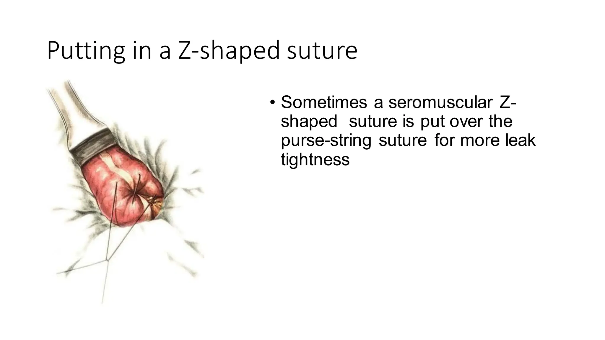 APPENDECTOMY PRESENTATION BY GENERAL SURGERY | PDF