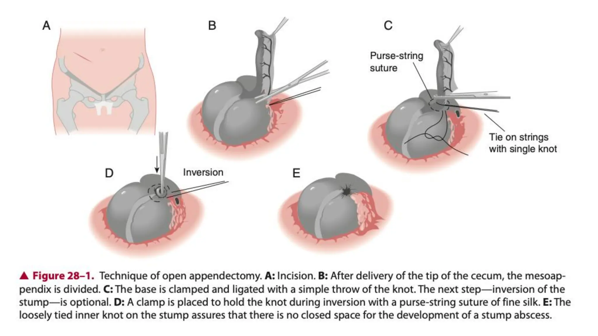APPENDECTOMY PRESENTATION BY GENERAL SURGERY | PDF