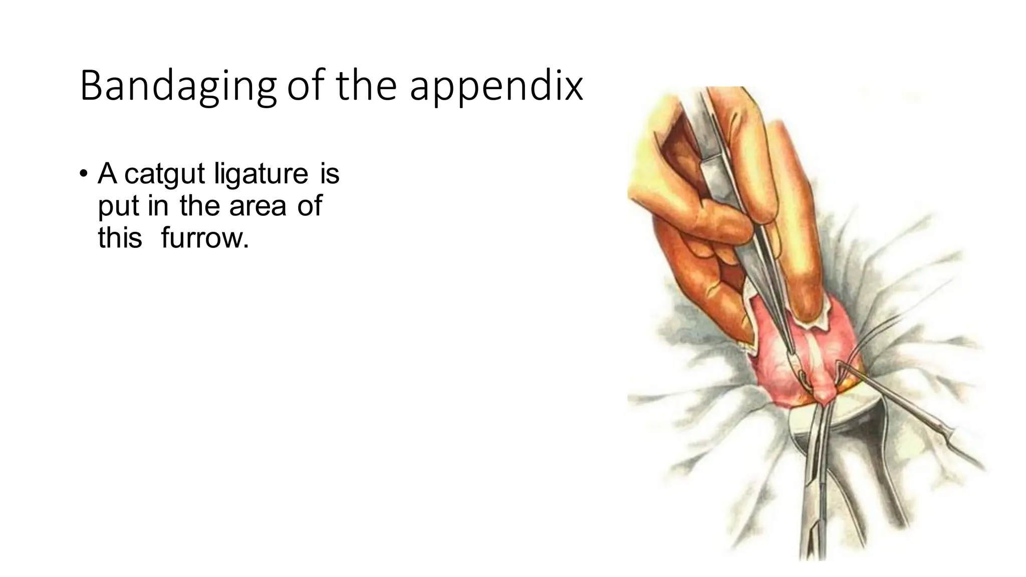 APPENDECTOMY PRESENTATION BY GENERAL SURGERY | PDF