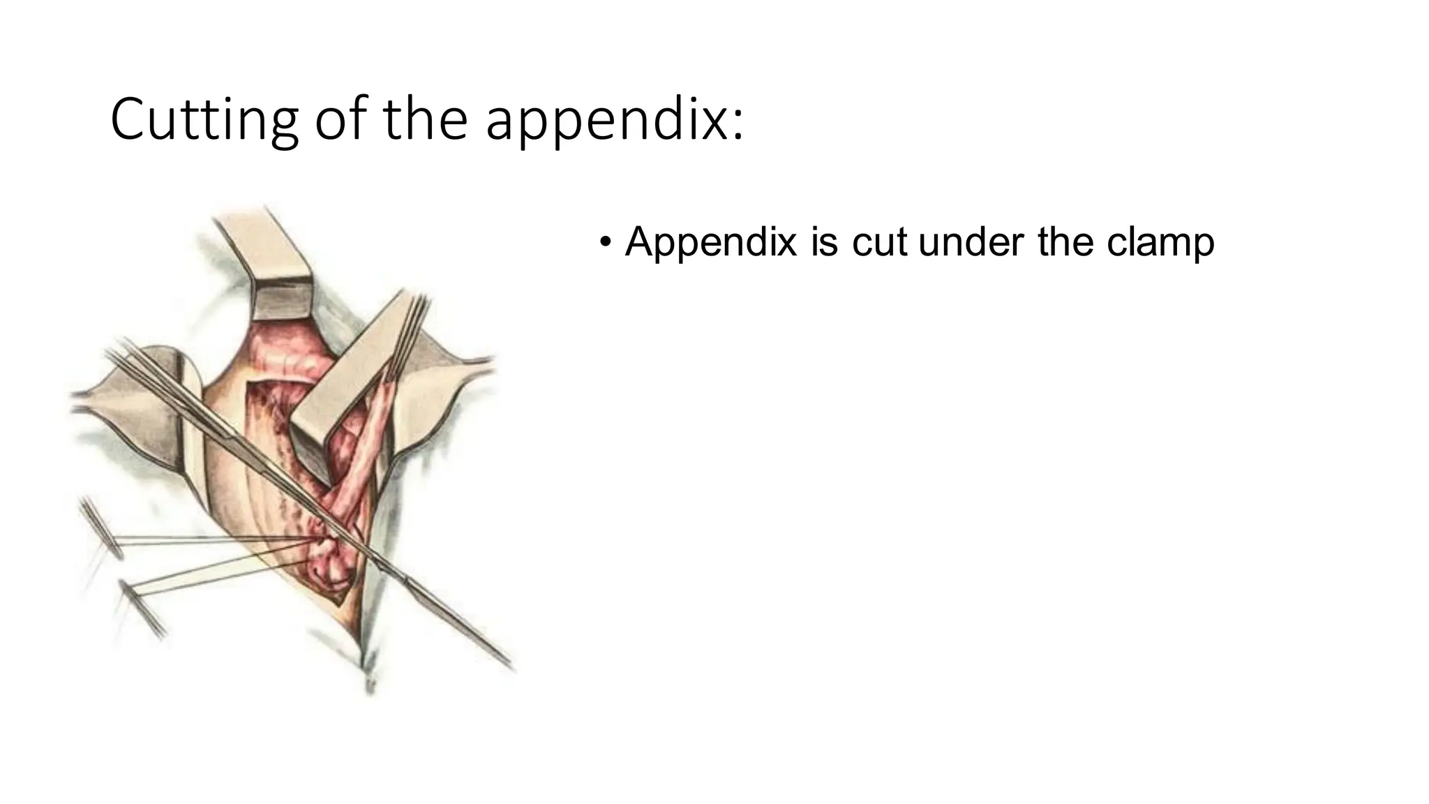 APPENDECTOMY PRESENTATION BY GENERAL SURGERY | PDF