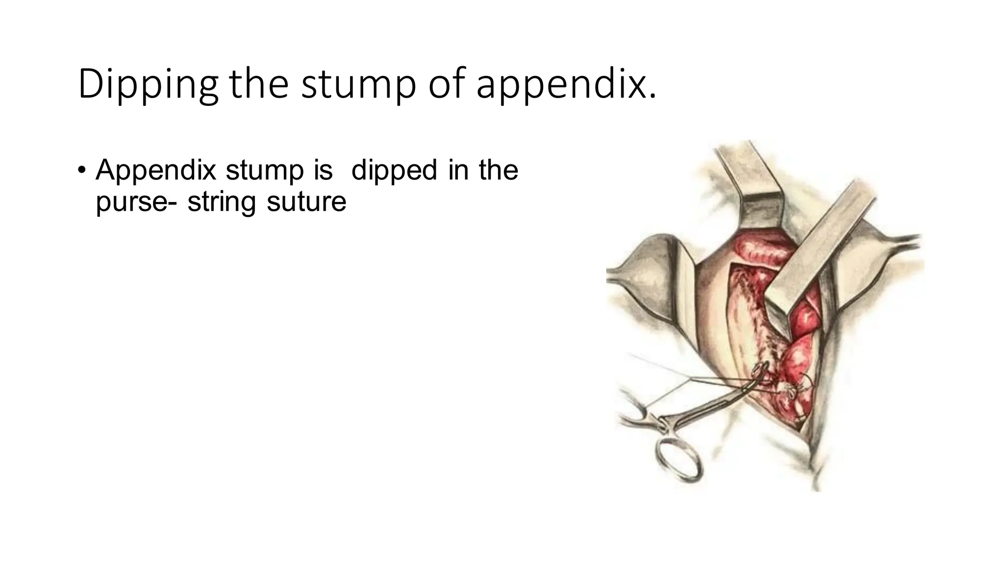 APPENDECTOMY PRESENTATION BY GENERAL SURGERY | PDF
