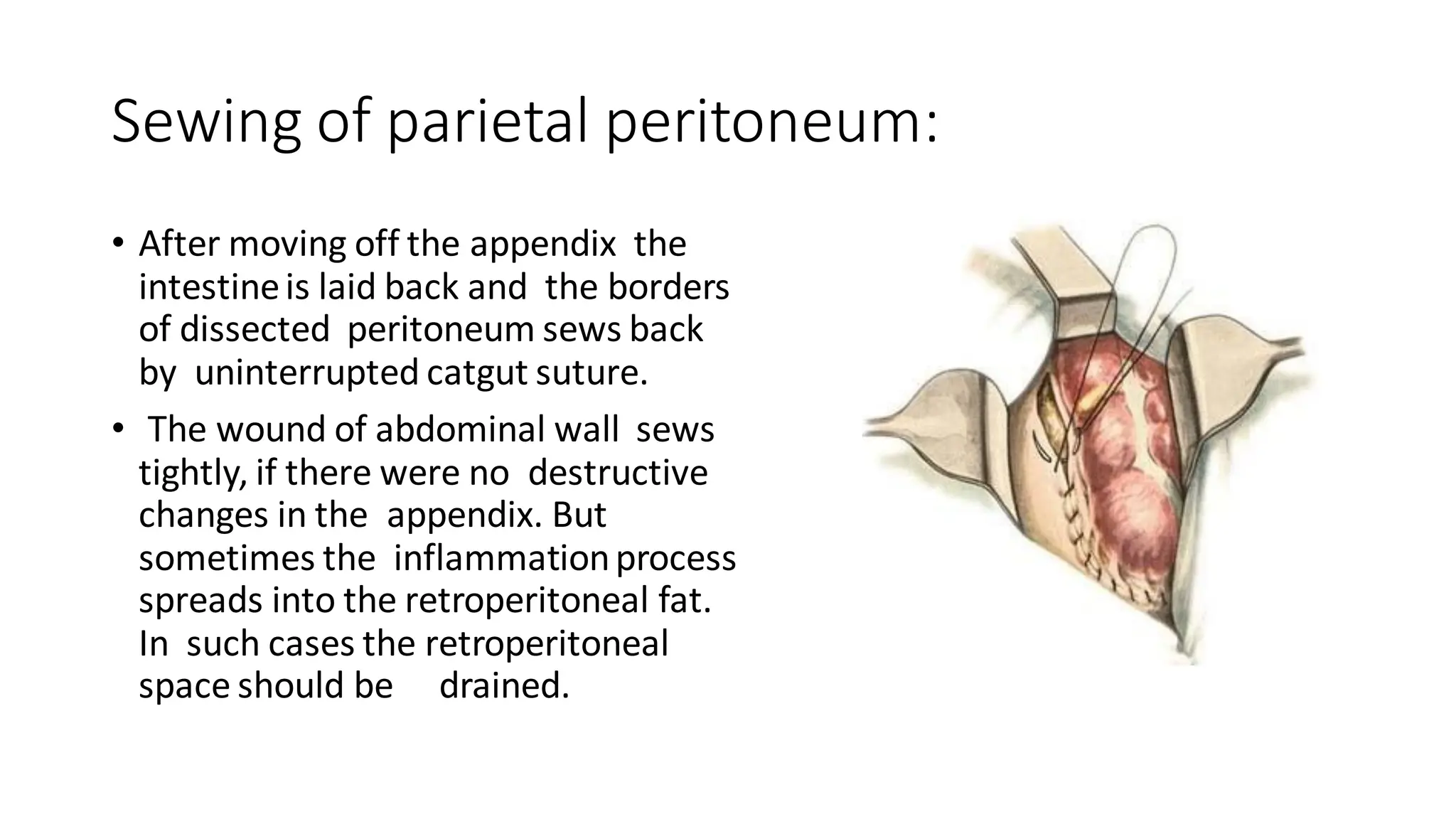 APPENDECTOMY PRESENTATION BY GENERAL SURGERY | PDF