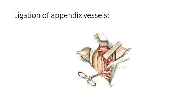 Appendectomy Presentation By General Surgery Ppt