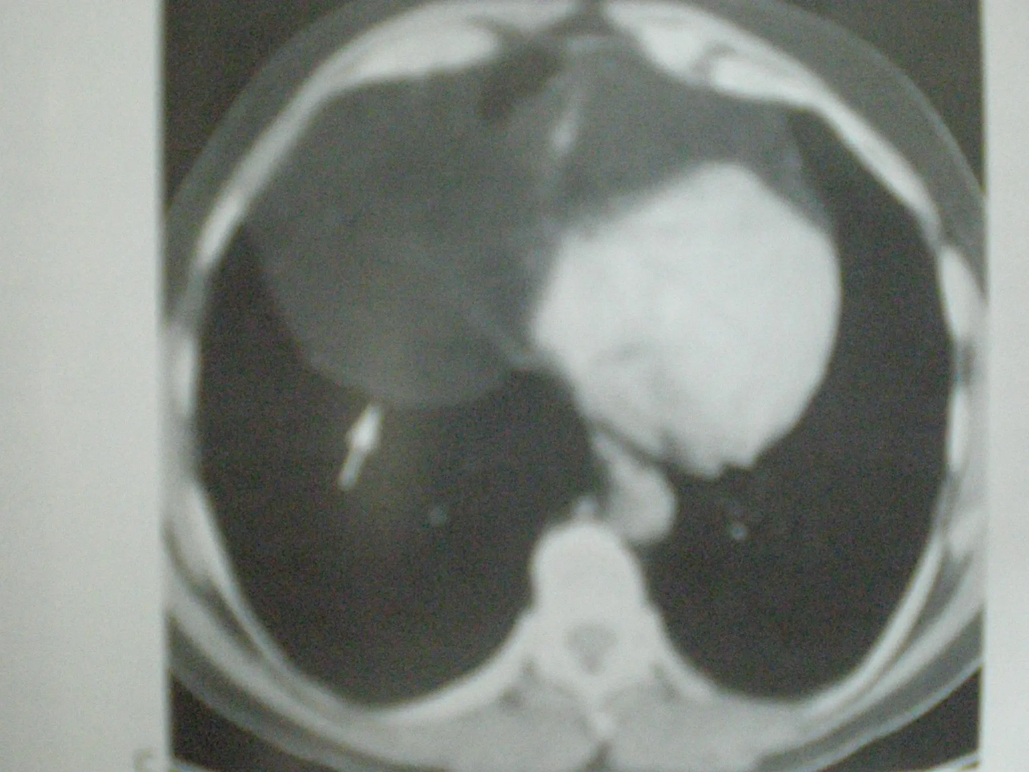 Mediastinal and lung masses xrays images radiology.pdf