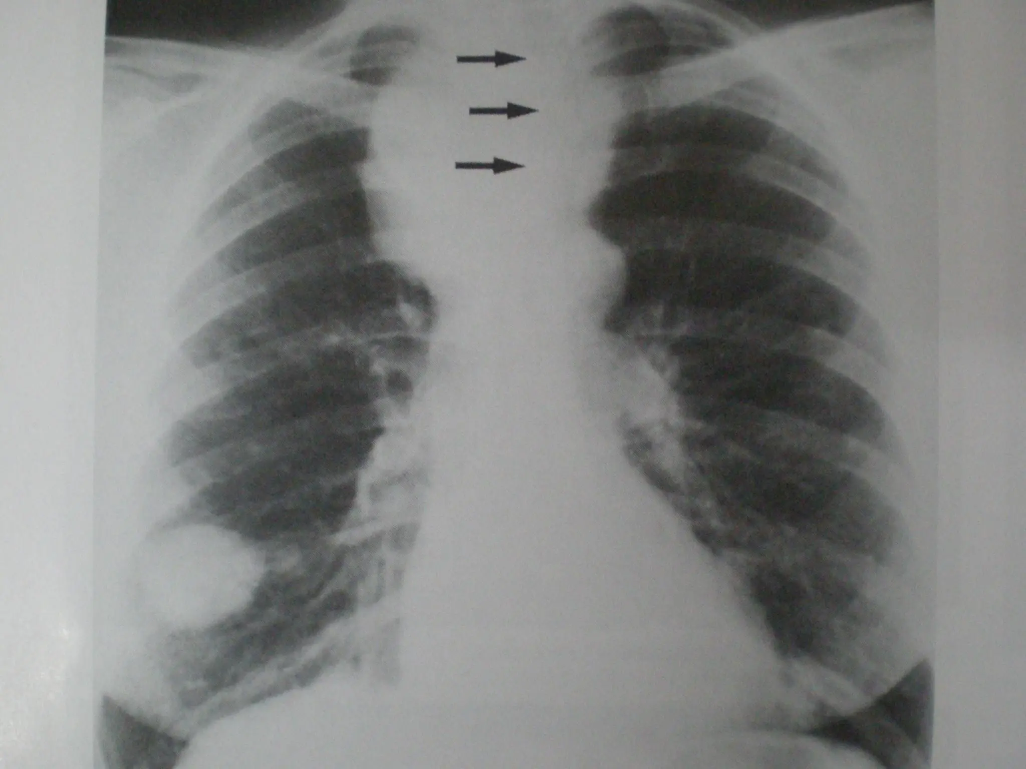 Mediastinal and lung masses xrays images radiology.pdf