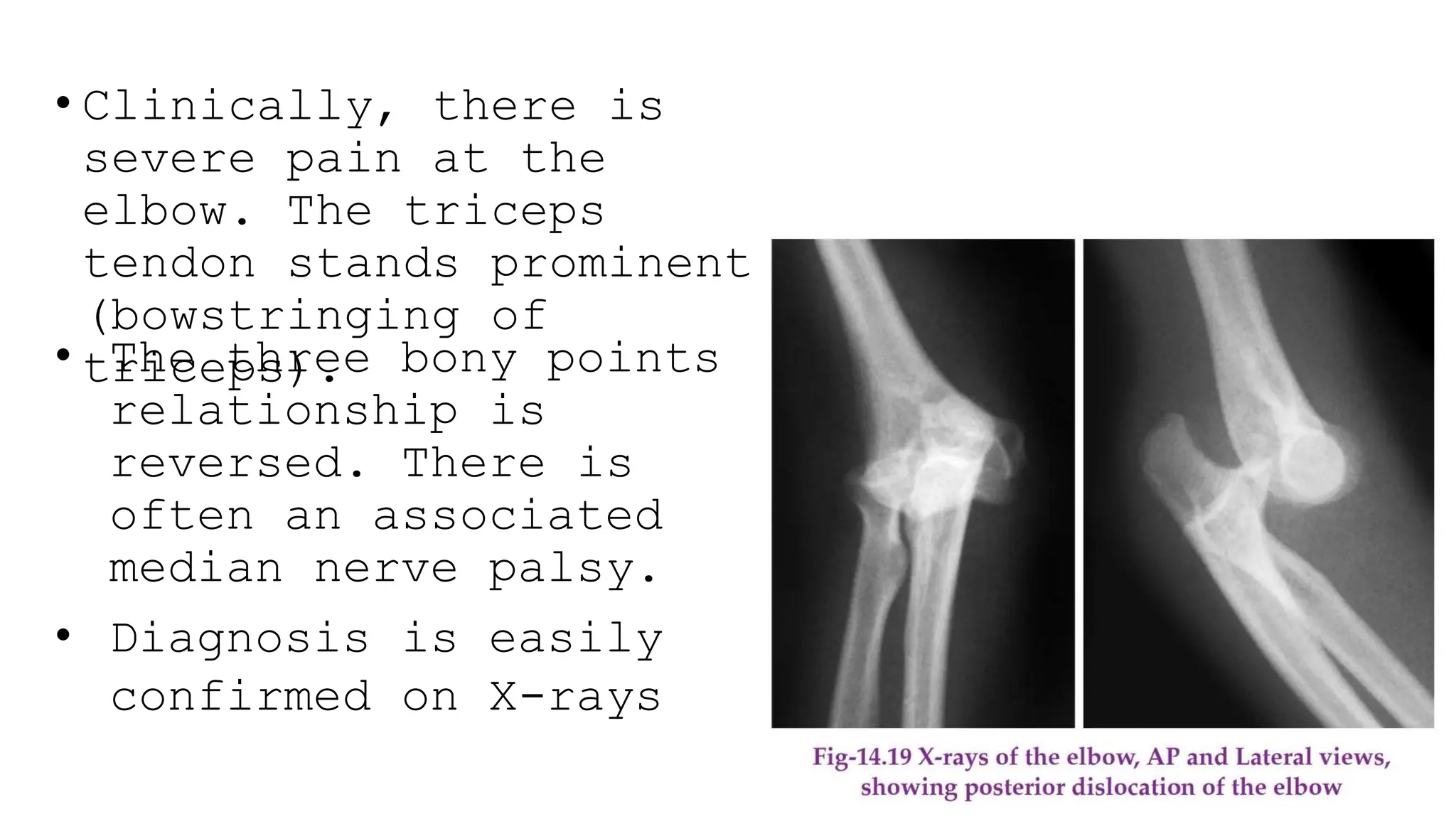 injuries around elbow joint orthopaedics ppt | PPTX