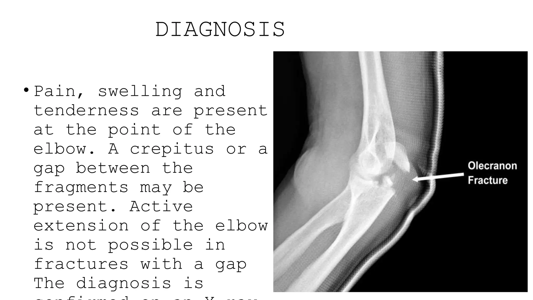 injuries around elbow joint orthopaedics ppt | PPTX