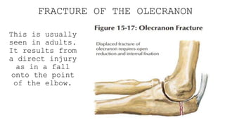injuries around elbow joint orthopaedics ppt | PPTX