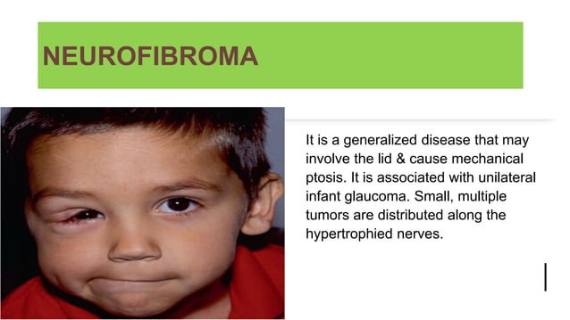 Eyelid deformities by Rutuja Mane bsc nursing | PPTX | Ear, Nose and Throat Conditions ...