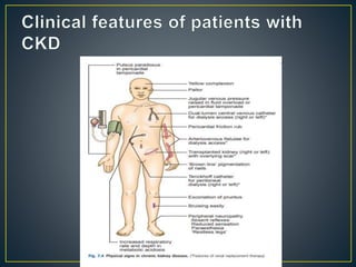 Diagnosis , staging , clinical features and management of CKD | PPTX