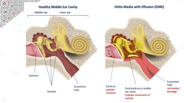 Otitis media22pediatrics chn nursing.pdf