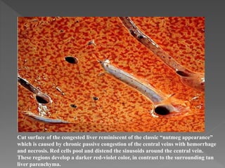 liver anatomy and cirrhosis-WA0022..pptx