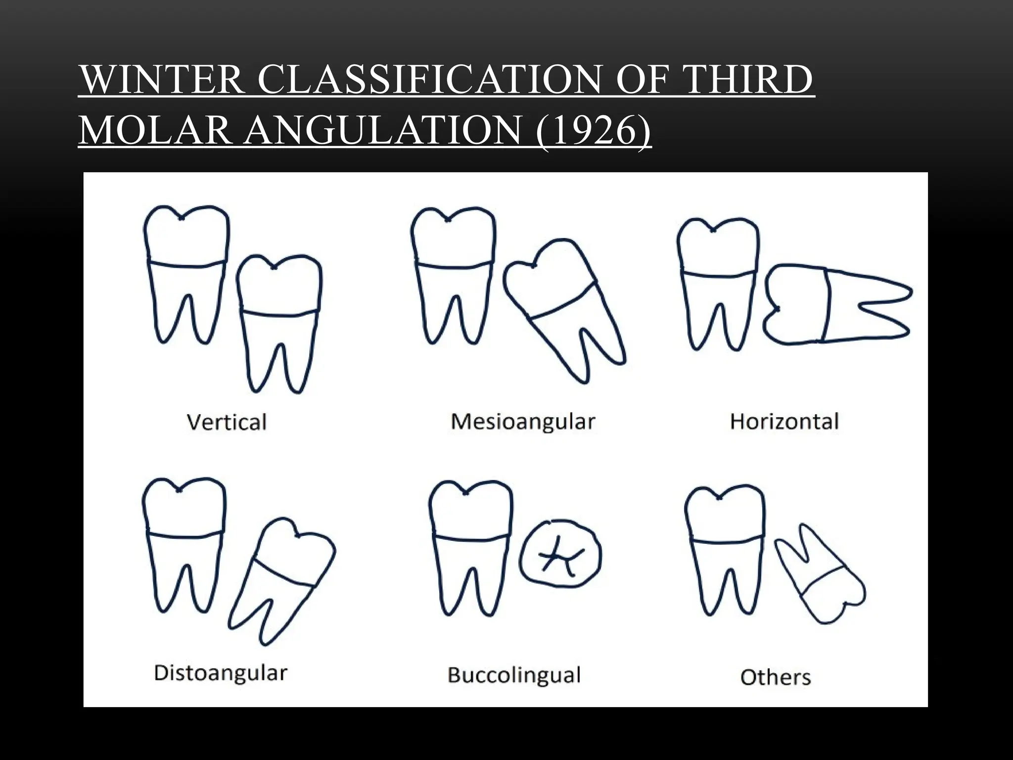 Pericoronitis, Distal pocket and Third Molar | PPTX