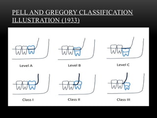 Pericoronitis, Distal pocket and Third Molar | PPTX