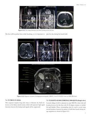 Magnetic Resonance Cholangiopancreatography (MRCP): Innovations in Non ...