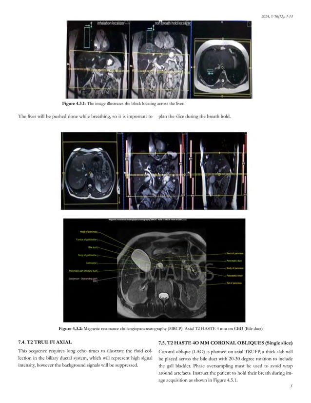 Magnetic Resonance Cholangiopancreatography (MRCP): Innovations in Non-Invasive Visualization of ...