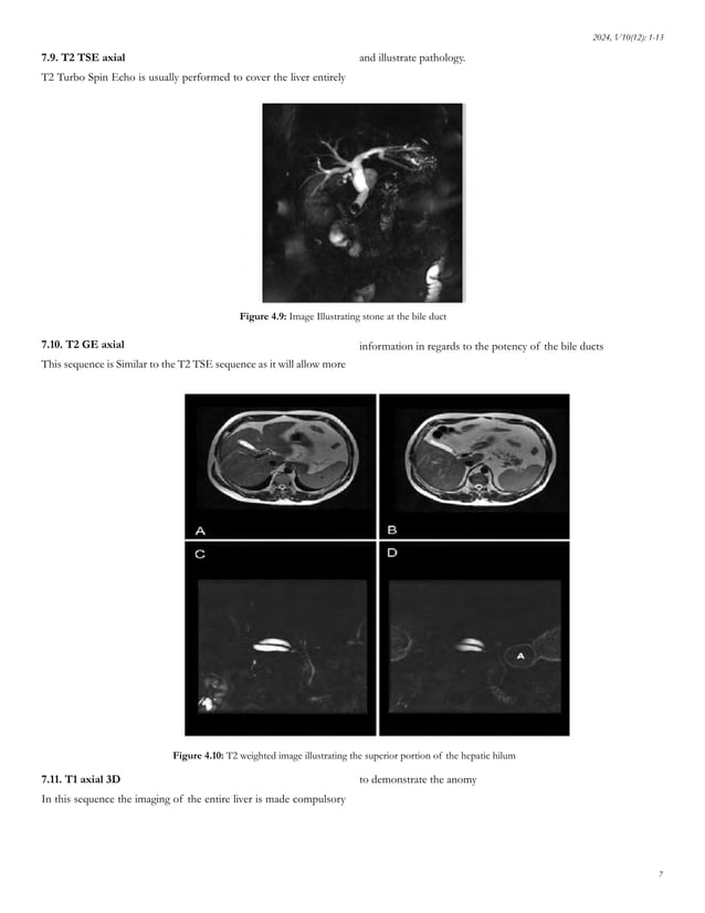 Magnetic Resonance Cholangiopancreatography (MRCP): Innovations in Non-Invasive Visualization of ...