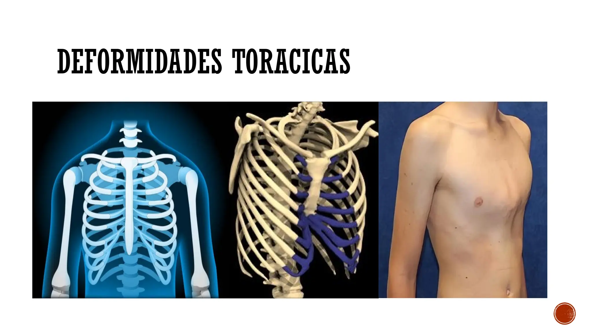 Deformidades toracicas con relación a pediatria | PPTX