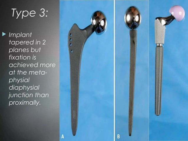 Total hip replacement and types of prosthesis | PPT
