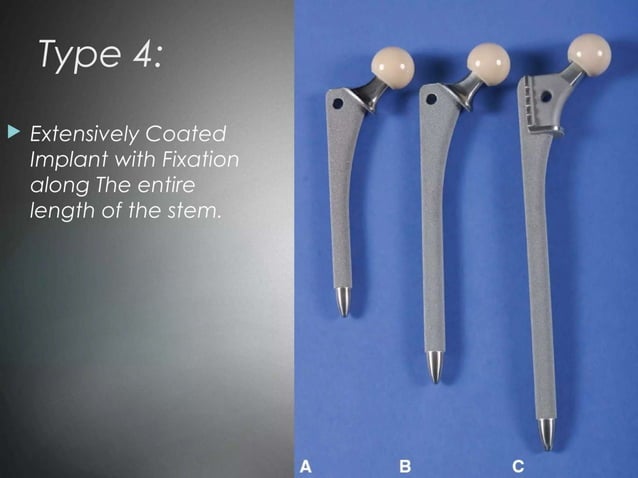 Total hip replacement and types of prosthesis | PPT