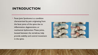Facet joint syndrome for normal individuals.pptx