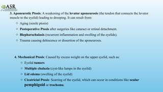 UNDERSTANDING PTOSIS:CAUSES,CLASSIFICATION, DIAGNOSIS, AND TREATMENT.pptx