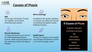 UNDERSTANDING PTOSIS:CAUSES,CLASSIFICATION, DIAGNOSIS, AND TREATMENT.pptx