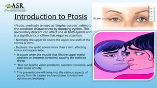 UNDERSTANDING PTOSIS:CAUSES,CLASSIFICATION, DIAGNOSIS, AND TREATMENT.pptx