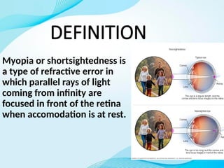 MyopiaMyopia or shortsightedness is a type of refractive error in which ...
