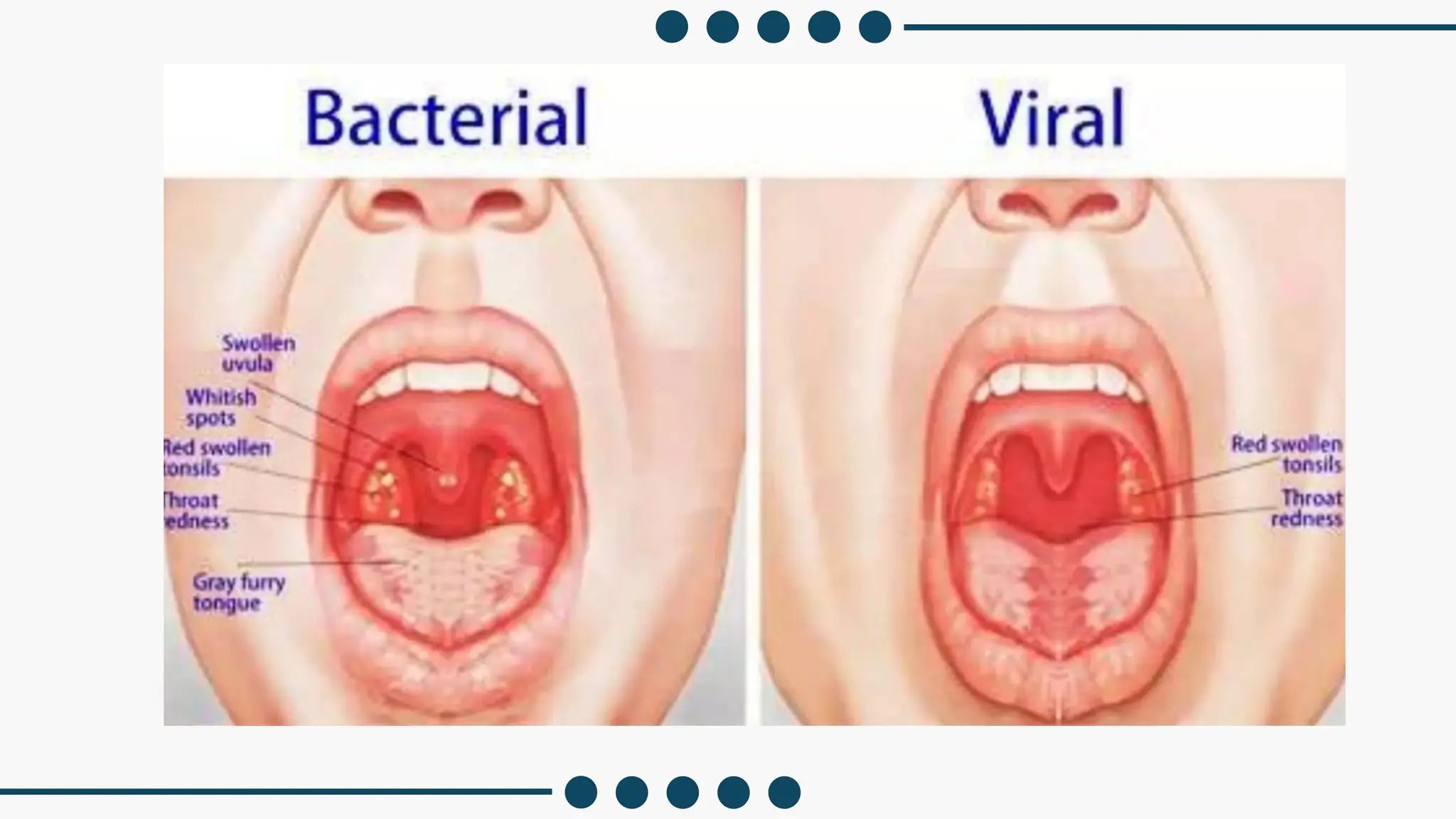 Acute tonsillitis and its several complications | PPTX