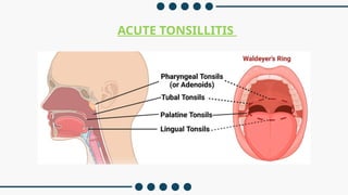 Acute tonsillitis and its several complications | PPTX