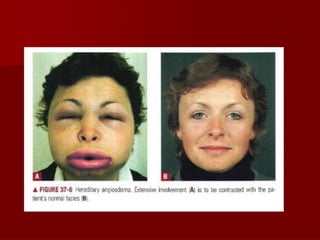 URTICARIA AND ANGIOEDEMA ANA ITS CAUSES AND TYPES | PPTX