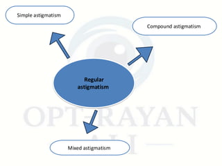 Astigmatism – Types, Causes, and Management | PDF