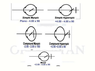 Astigmatism – Types, Causes, and Management | PDF