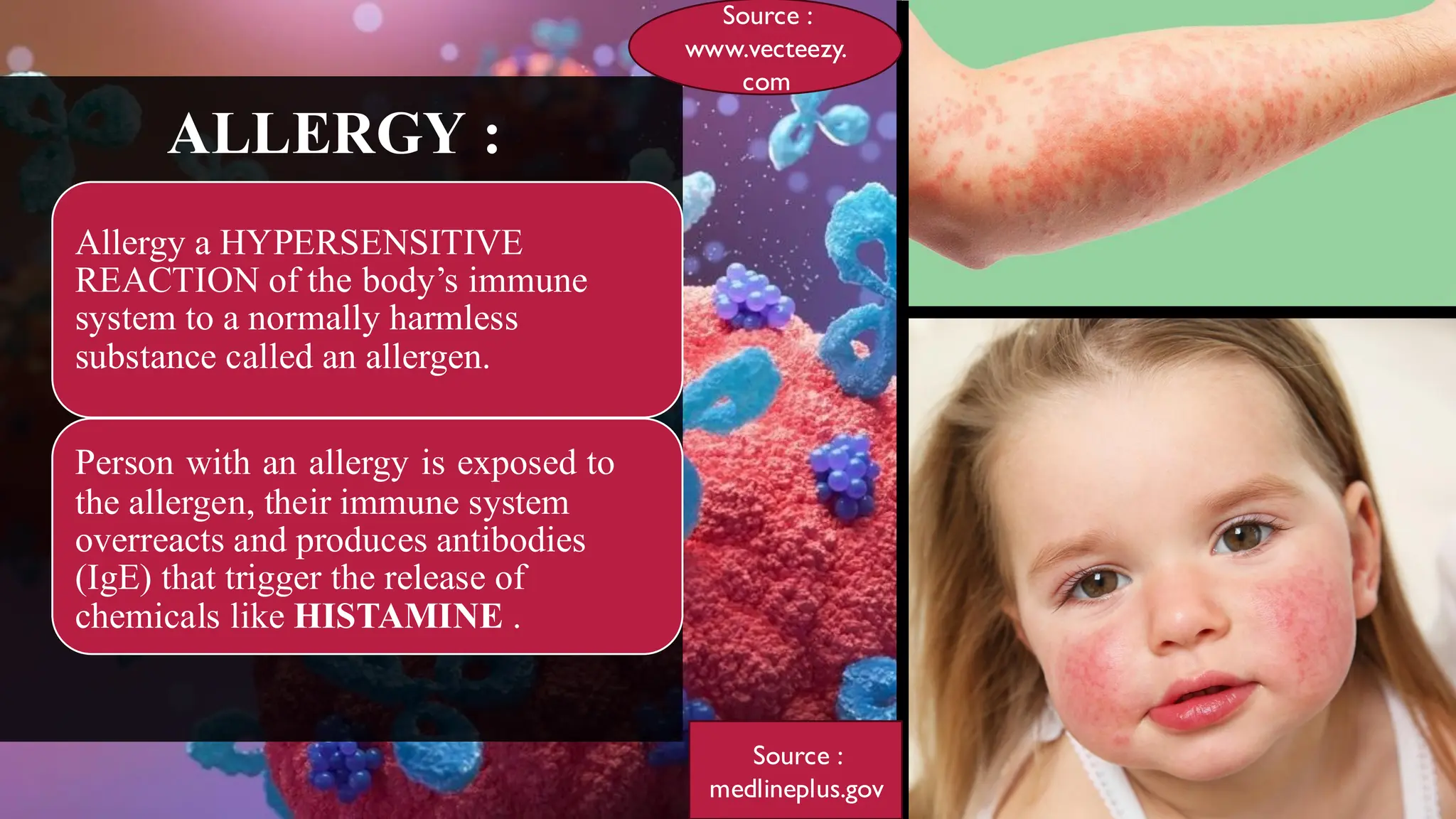 Allergy and Type - 1 , Type - 2 and 3 with mechanism and their symptoms ...
