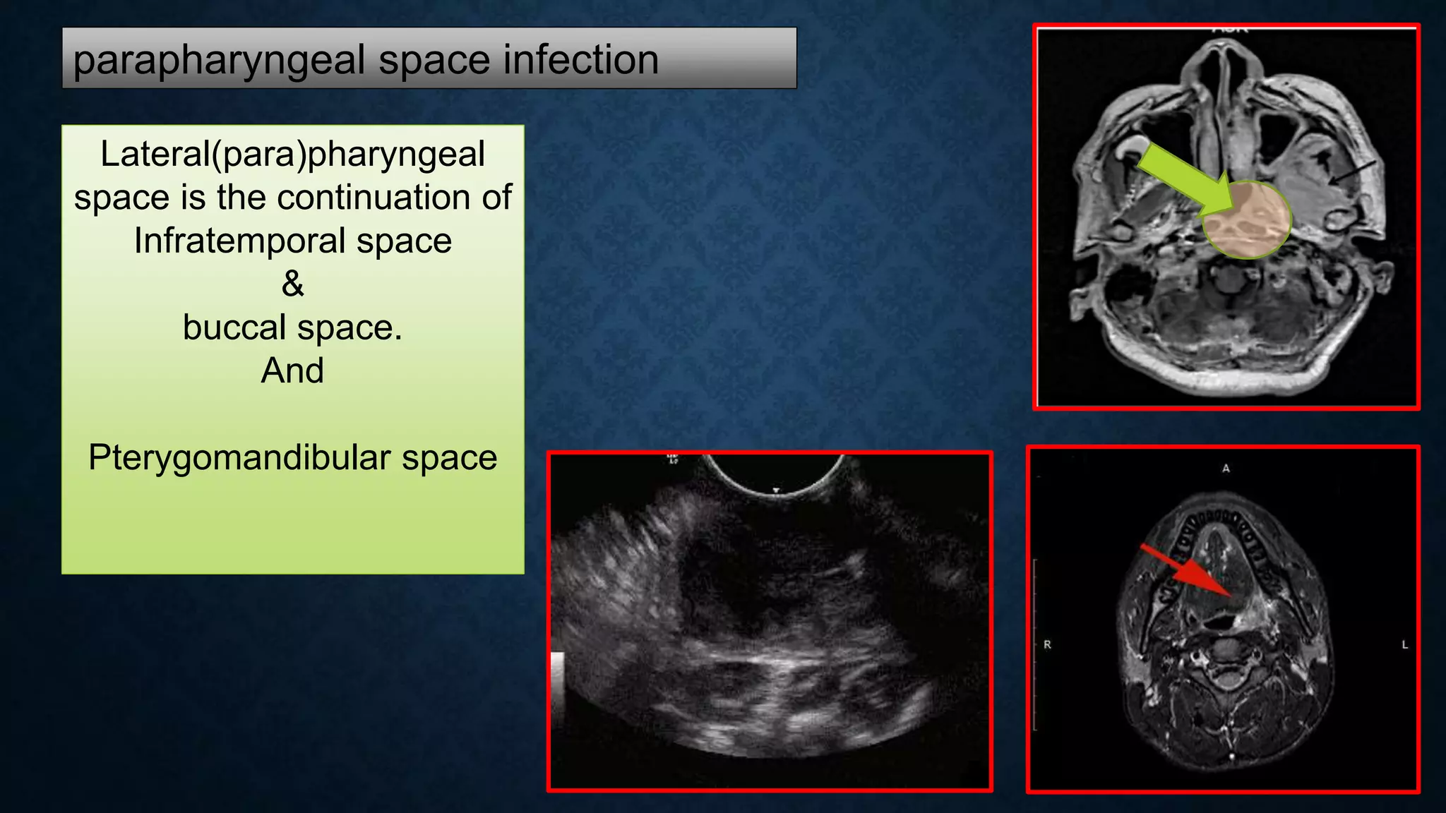Fatal complications of maxillofacial infection | PPT