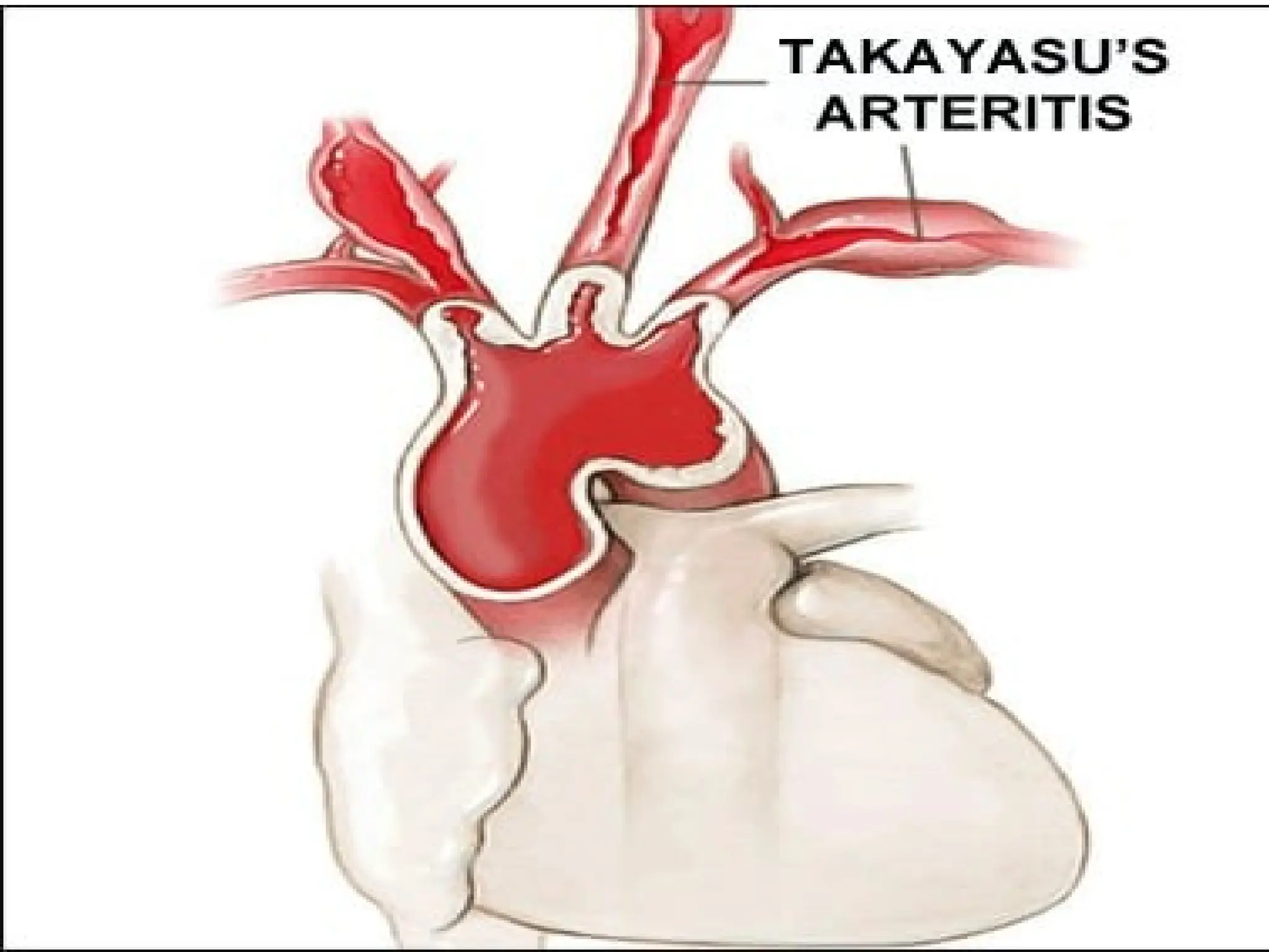 TAKAYASU'S ARTERITIS OVERVIEW OF MEDICAL SURGICAL NURSING..pptx